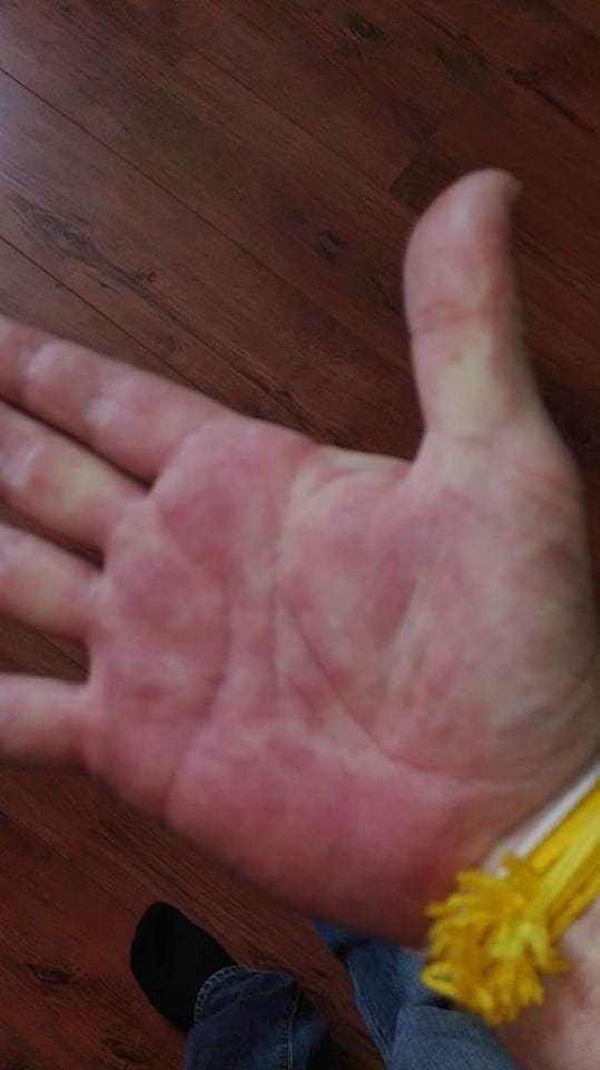 Handpalmen rood gevlekt - Medische Forum - Dokter.nl