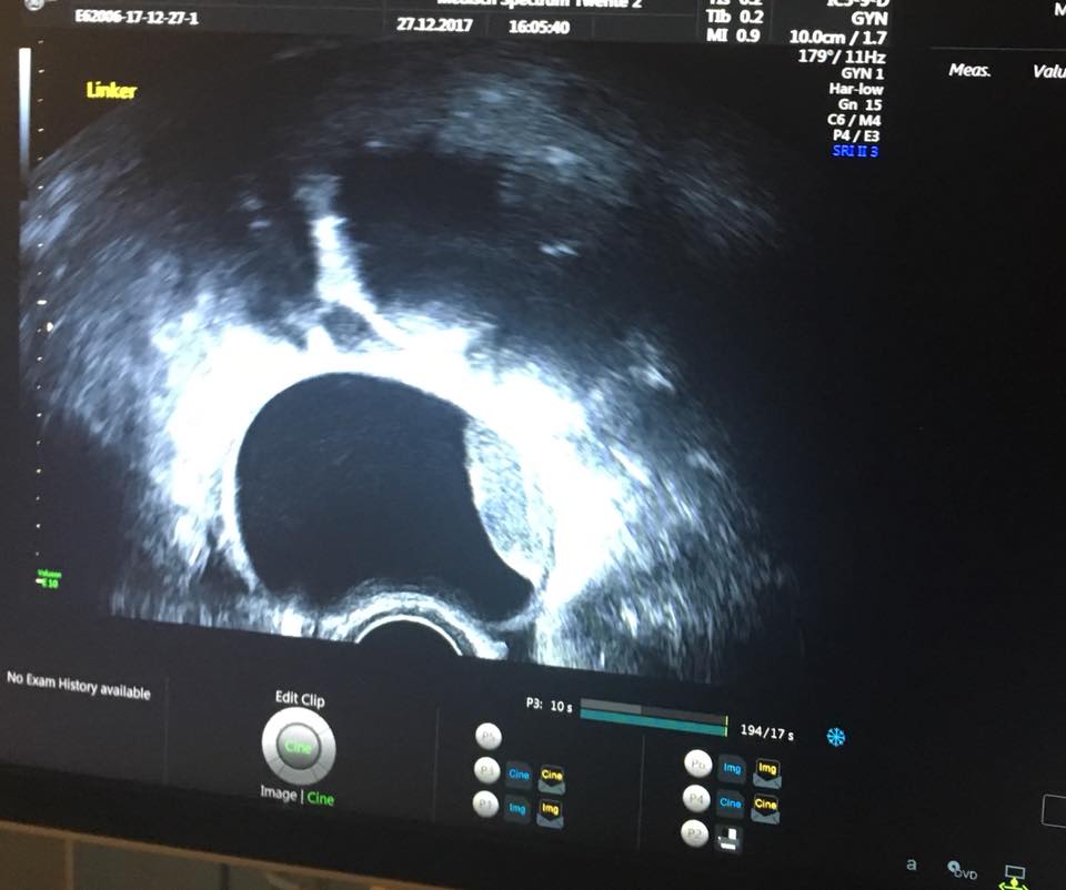 Echo afwijking eierstok? - Medische Forum - Dokter.nl