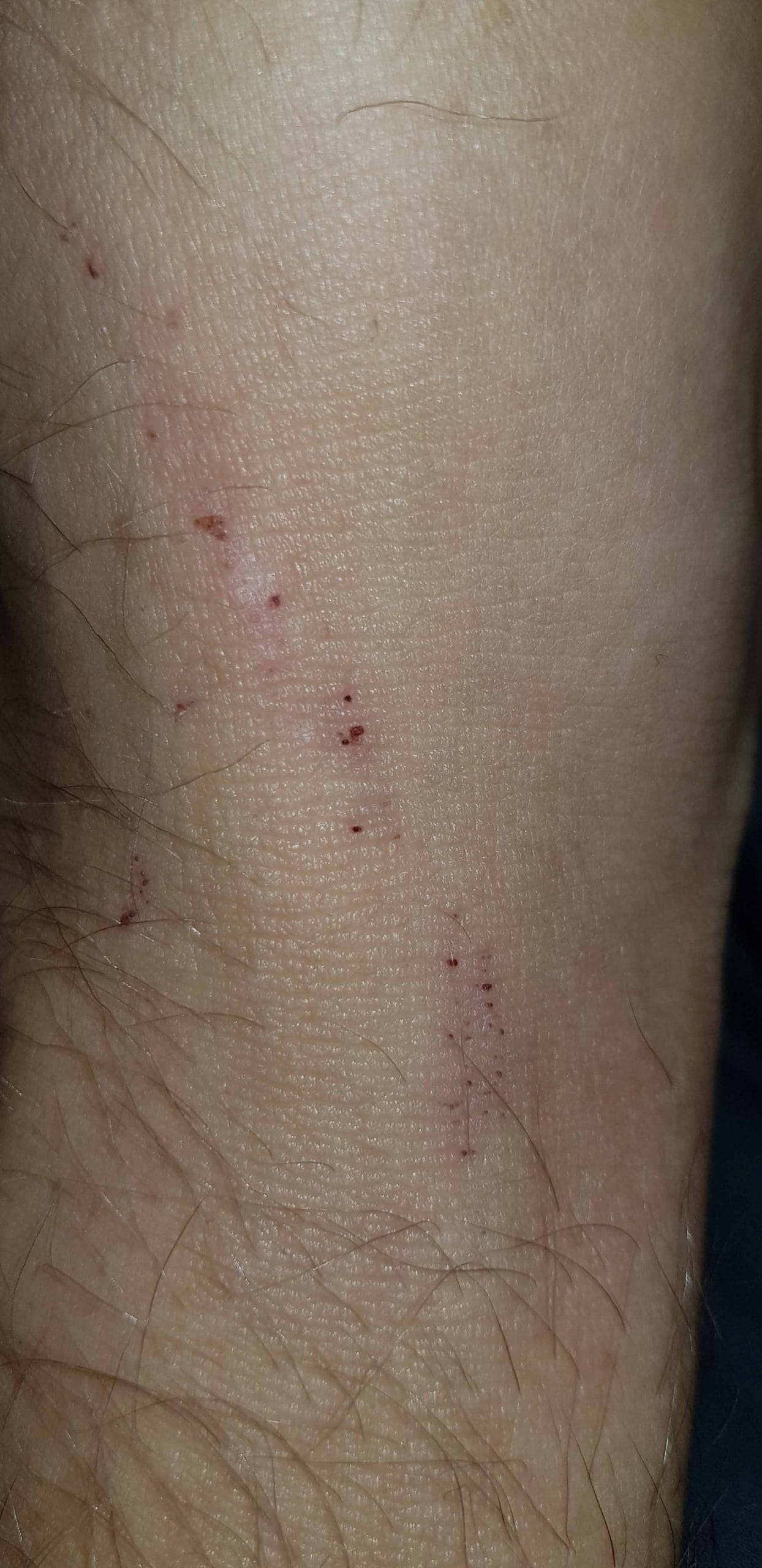 Heb ik Scabies(schurft)? - Medische Forum - Dokter.nl