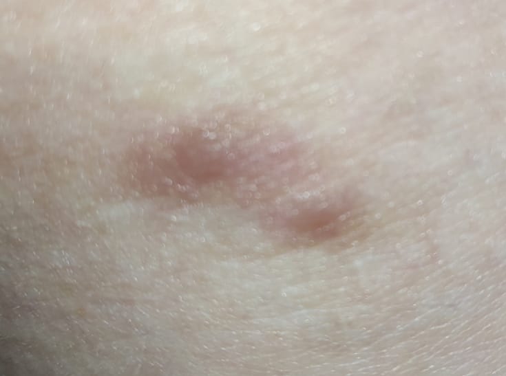 Huiduitslag. Post schurft? Door permetrine? Rode bulten - Medische ...