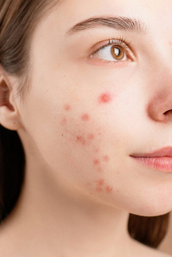 Hormonale acne: oorzaak, symptomen en effectieve behandeling - Dokter.nl